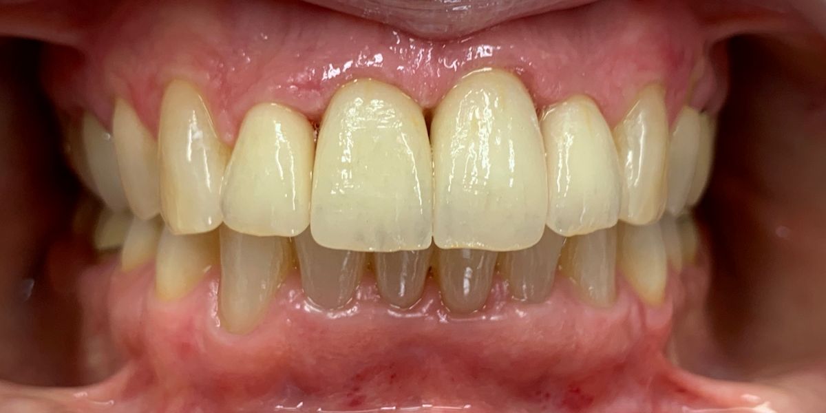 Successful, overall esthetic outcome with pre-prosthetic clear aligners